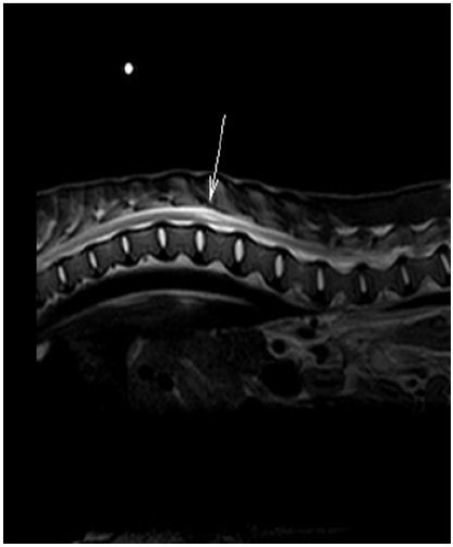 Figure 1 : Sagittal T2-weighted magnetic resonanceimage showing ...