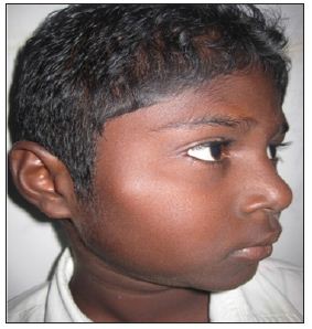 Figure 2: Homogenous Hypoechoic Mass with SlightInternal Echo Lateral ...