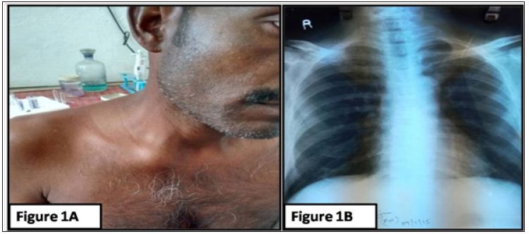 Figure 1: A) Patient having a swelling on the medial end of right ...