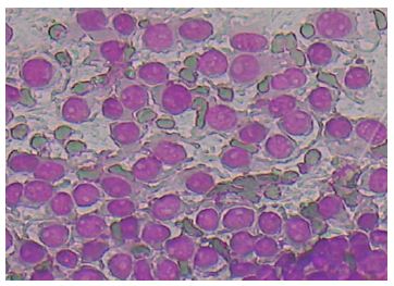 Figure 1B: These cells have pale, vacuolated, round nucleiwith opened ...