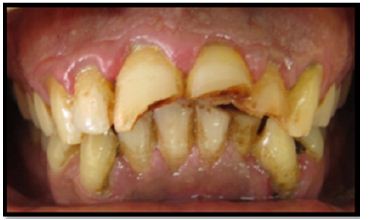 b. Grade II mobility was present with 11, 21 & 22.