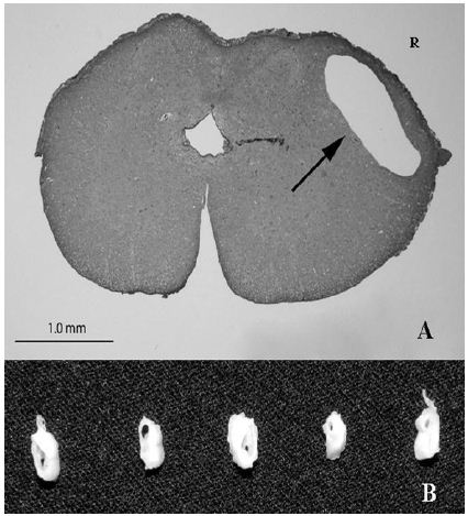 Figure 1 : Sagittal T2-weighted magnetic resonanceimage showing ...