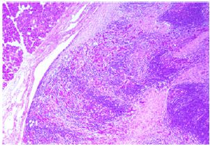 Figure 3: [H+E x 20] The high power view shows atrophicacini, stromal ...