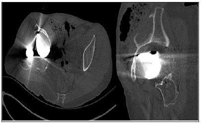 Figure 3: Clinical photographs showing the plastic modelfor trial and ...