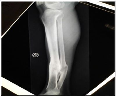 Preoperative Planning For Correction of Malalignment