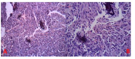 Figure 4: Anterior-posterior radiograph of the righthumerus with ...