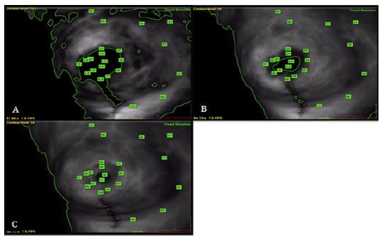 Figure 5 : Low perfusion in the inferior skin pocket ofthe right breast ...