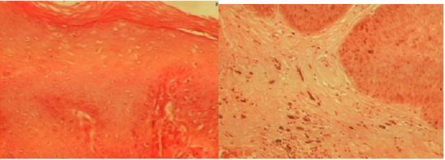 Giant Cumulated Condyloma (Tumor of Buschke Lõwenstein) Presentation of ...