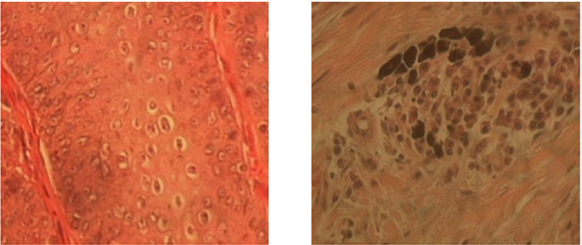 Giant Cumulated Condyloma (Tumor of Buschke Lõwenstein) Presentation of ...