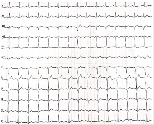 Permanent His-Bundle Pacing in The Right Atrium in A Patient with A ...
