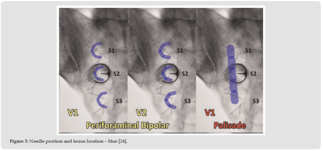 Radiofrequency Ablation Sacroiliac Joint Pain