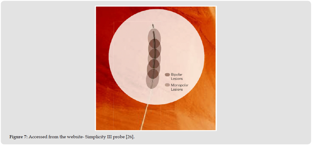 Radiofrequency Ablation Sacroiliac Joint Pain