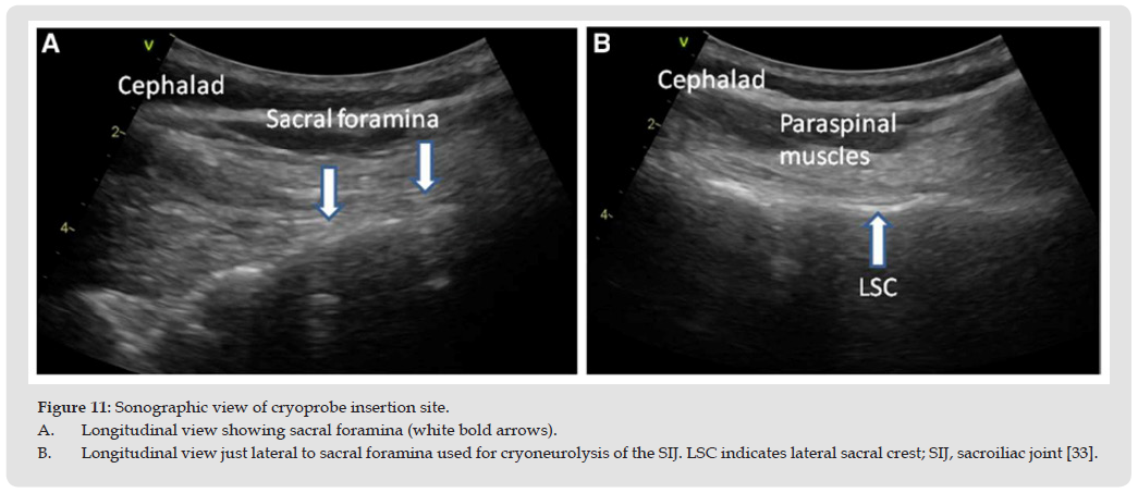 Radiofrequency Ablation Sacroiliac Joint Pain