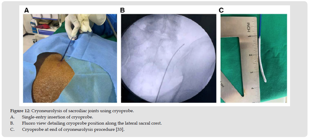 Radiofrequency Ablation Sacroiliac Joint Pain