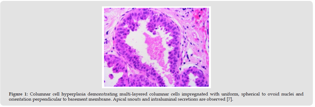 The Aggrandized Cavalcade Columnar Cell Hyperplasia
